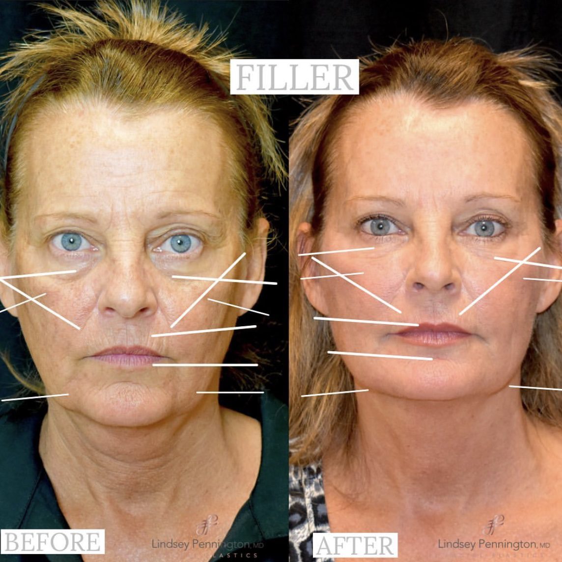 What Are Cosmetic Injections? | Lola Magazine