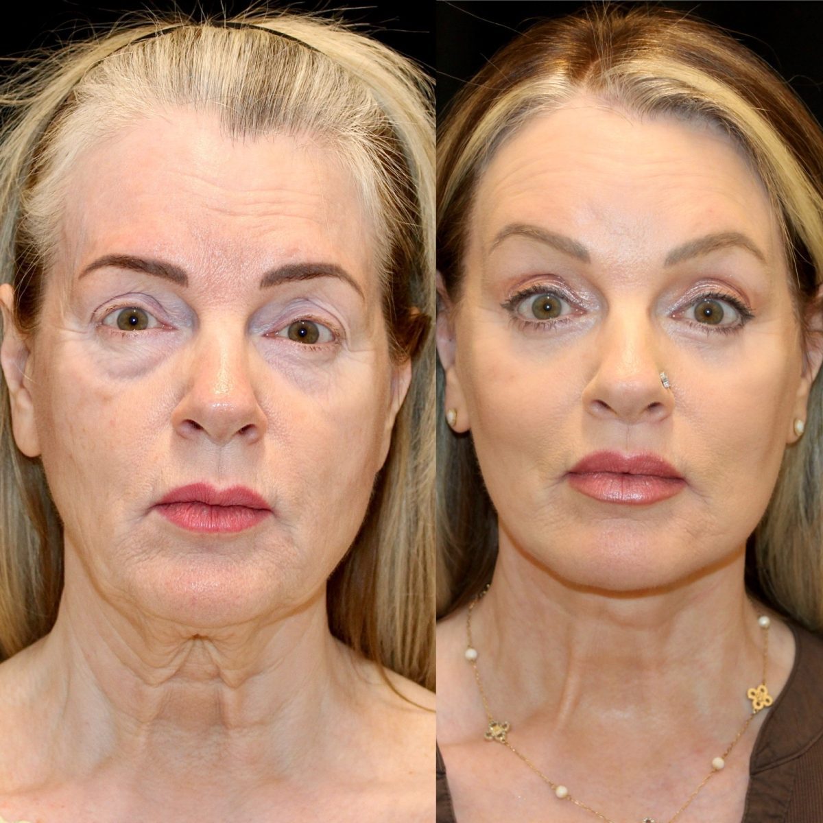 The Face Effect of GLP-1 Weight Loss | Lola Magazine